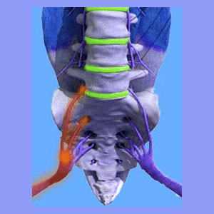 Best Drugs for Sciatica - Sciatica