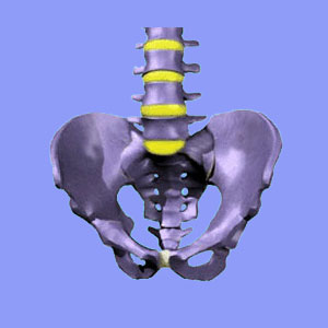 Bursitis Sciatica - Sciatica