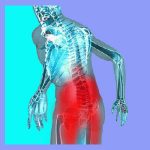 Chronic Sciatica Sciatica