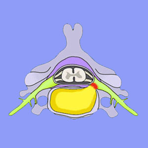 Herniated Disc - Sciatica