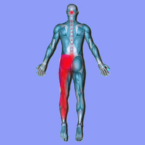 Ischemic Sciatica - Sciatica