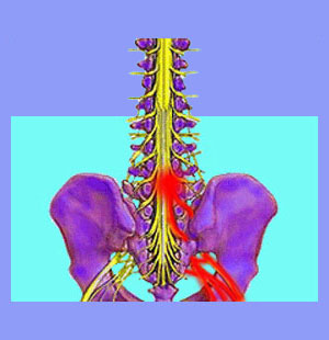 Managing Sciatica - Sciatica