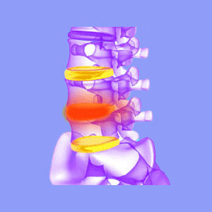 Nucleoplasty for Sciatica - Sciatica