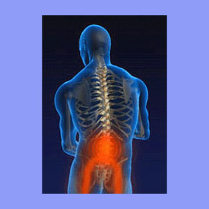 Poor Posture Sciatica - Sciatica