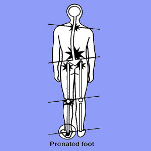 Pronated Foot Sciatica - Sciatica