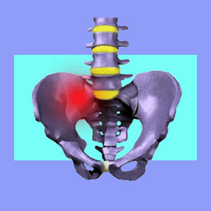 Sacroiliac Pain - Sciatica