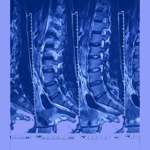 Sciatica MRI - Sciatica