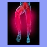Sciatica Flare-Up - Sciatica