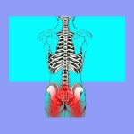 Sciatica in Children - Sciatica