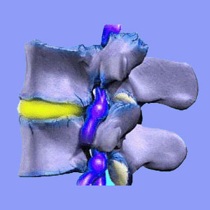 Sciatica Nerve Compression - Sciatica