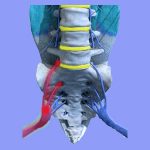 Sciatica Neuropathy - Sciatica