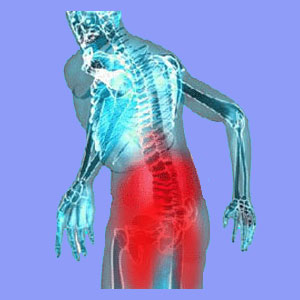 Short Leg Sciatica - Sciatica